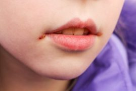 7 Home Remedy for Mouth Ulcer in Children during Summers