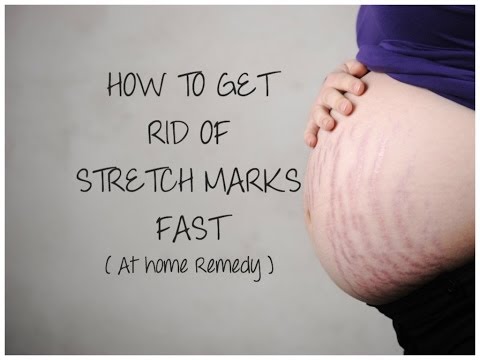 How to Get Did of Stretch Marks: 30 Home Remedies