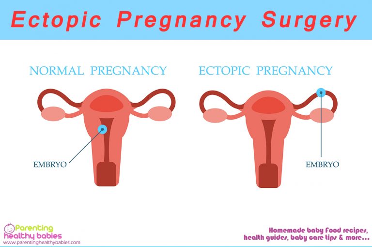Ultimate Guide for Ectopic Surgery and Recovery Time