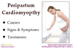 Peripartum Cardiomyopathy: Causes, Signs and Symptoms