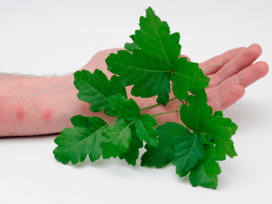 Poison Ivy Infection: Symptoms, Prevention and Home Remedy