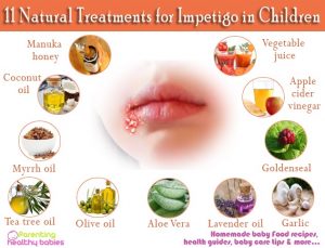 11 Natural Treatments for Impetigo in Children