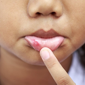 Cause and Treatment of Canker Sores in Children
