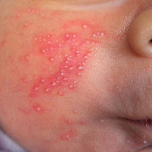 neonatal candida