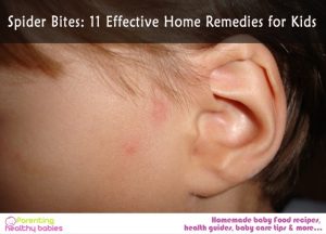 Spider Bites: 11 Effective Home Remedies for Kids