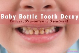 Baby Bottle Tooth Decay- Causes, Prevention and Treatment