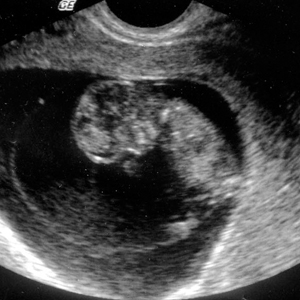 Ultrasound At 10 Weeks – All You Need To Know