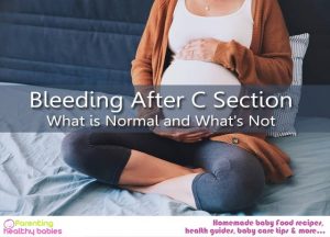 Bleeding after C section -What is Normal and What's not