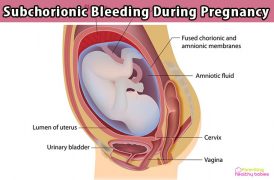 Subchorionic Bleeding During Pregnancy: Symptoms, Causes Treatment and Diagnosis.