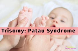 Trisomy 13 Patau syndrome: Infant Birth Defect