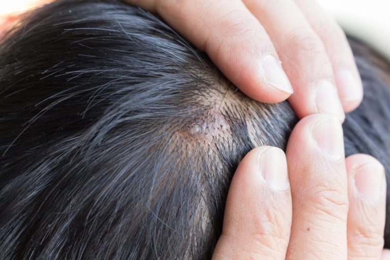 11 Best Home Remedies to Improve Scalp Psoriasis