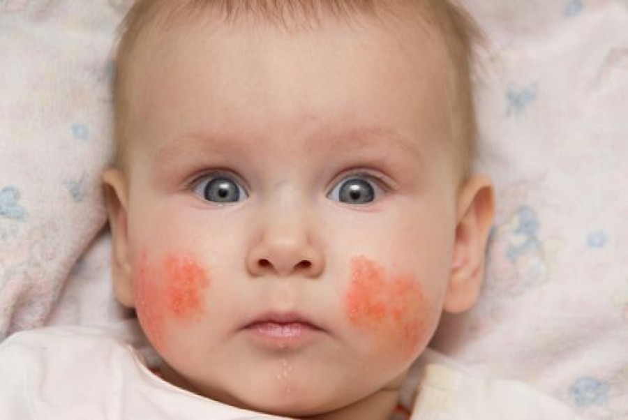 All You Need To Know About Slapped Cheek Disease In Children All You Need To Know About Slapped Cheek Disease In Children