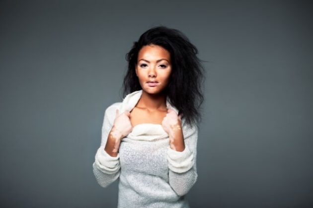 Leucoderma: Causes, Symptoms & Treatment | Parentinghealthybabies