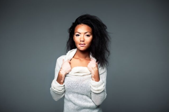 Leucoderma: Causes, Symptoms & Treatment | Parentinghealthybabies