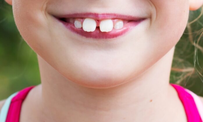 Buck Teeth: Causes, Risks and Treatment